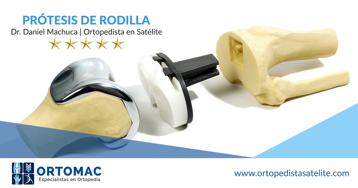 Especialista en Cirugía de Prótesis de Rodilla | Dr. Daniel Machuca
